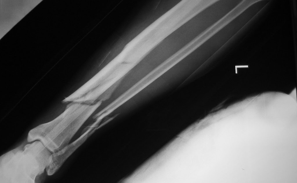 Tibia Fracture Treatment | Tibia Bone Fracture Surgery