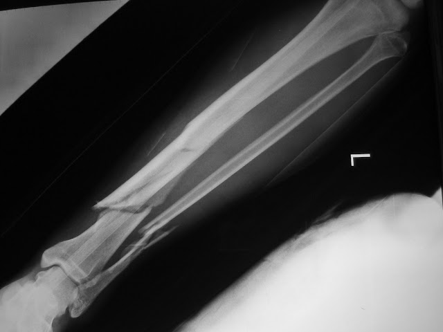 Tibia Fracture Treatment | Tibia Bone Fracture Surgery