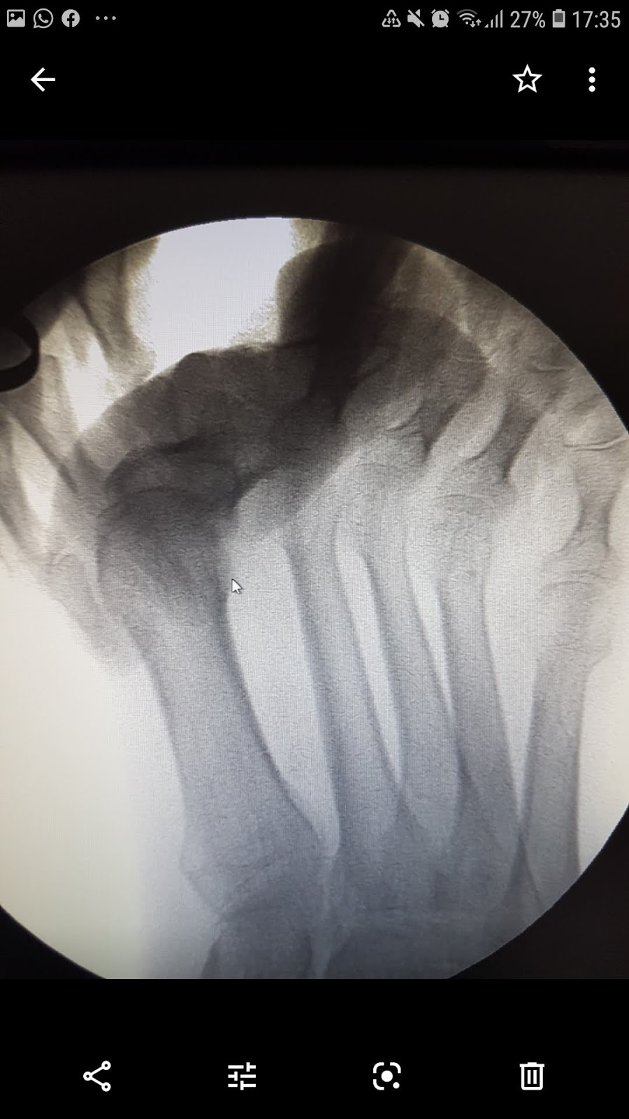 Podo Basas al Día: Alargamiento de gastrocnemio. Papilomas con ...