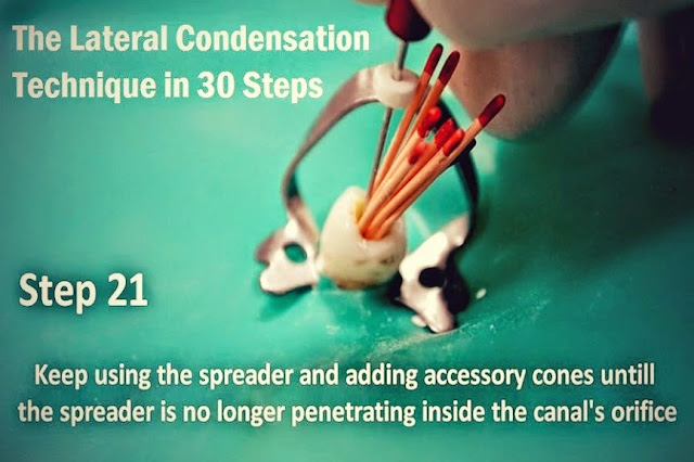 ENDODONTIC: The Lateral Condensation Technique in 30 Steps