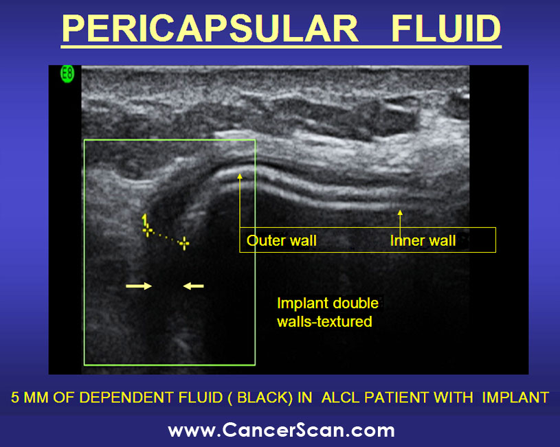 Modern Diagnostic Science: Cancer Alert: Breast Implant Associated ...