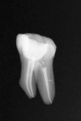 Dentistry and Medicine: Purpose of Root Canal Obturation and method of ...