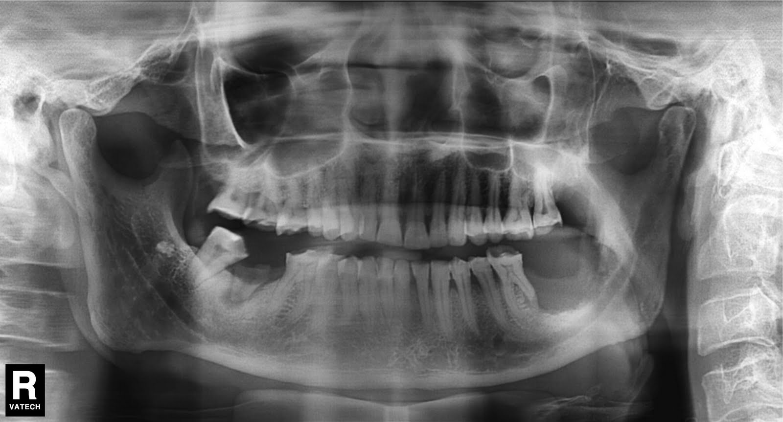 oral medicine and radiology: progressing malignancy and its effect on ...
