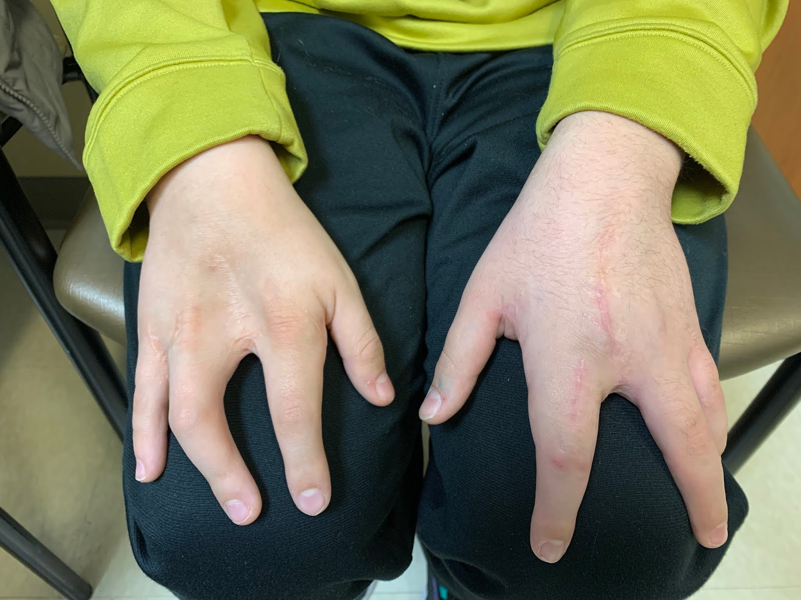 Cleft Hand: Beyond the Basics | Congenital Hand and Arm Differences ...