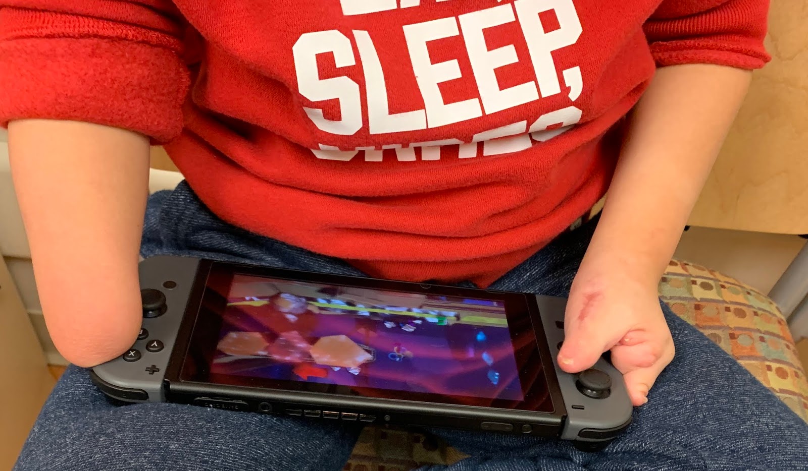 Amniotic Constriction Band- how we can help function | Congenital Hand ...