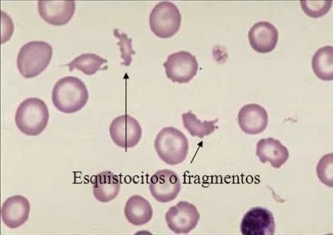 FICHERO DE HEMATOLOGIA: ESQUISTOCITOS
