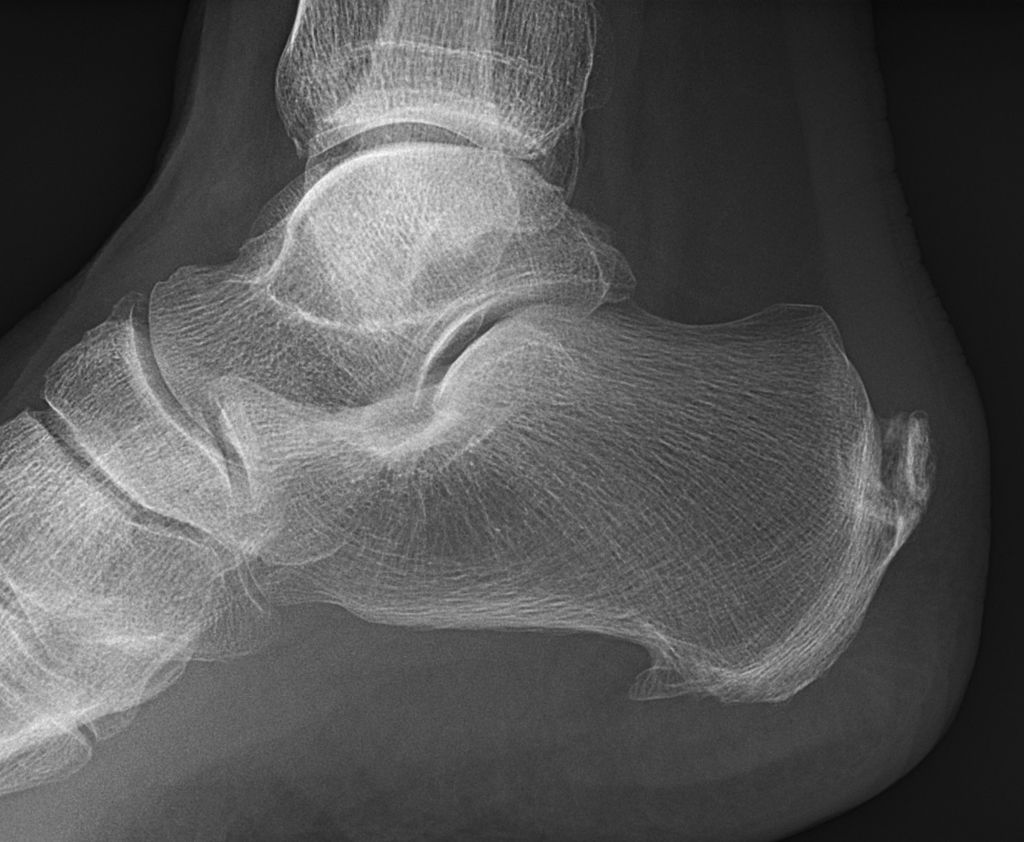 Professor Hylton B Menz: Are calcaneal spurs indicative of generalised ...