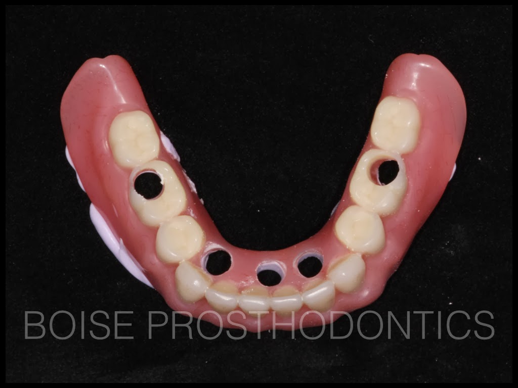 Boise Idaho Prosthodontics: Immediate Load Implant Prosthesis - Hybrid