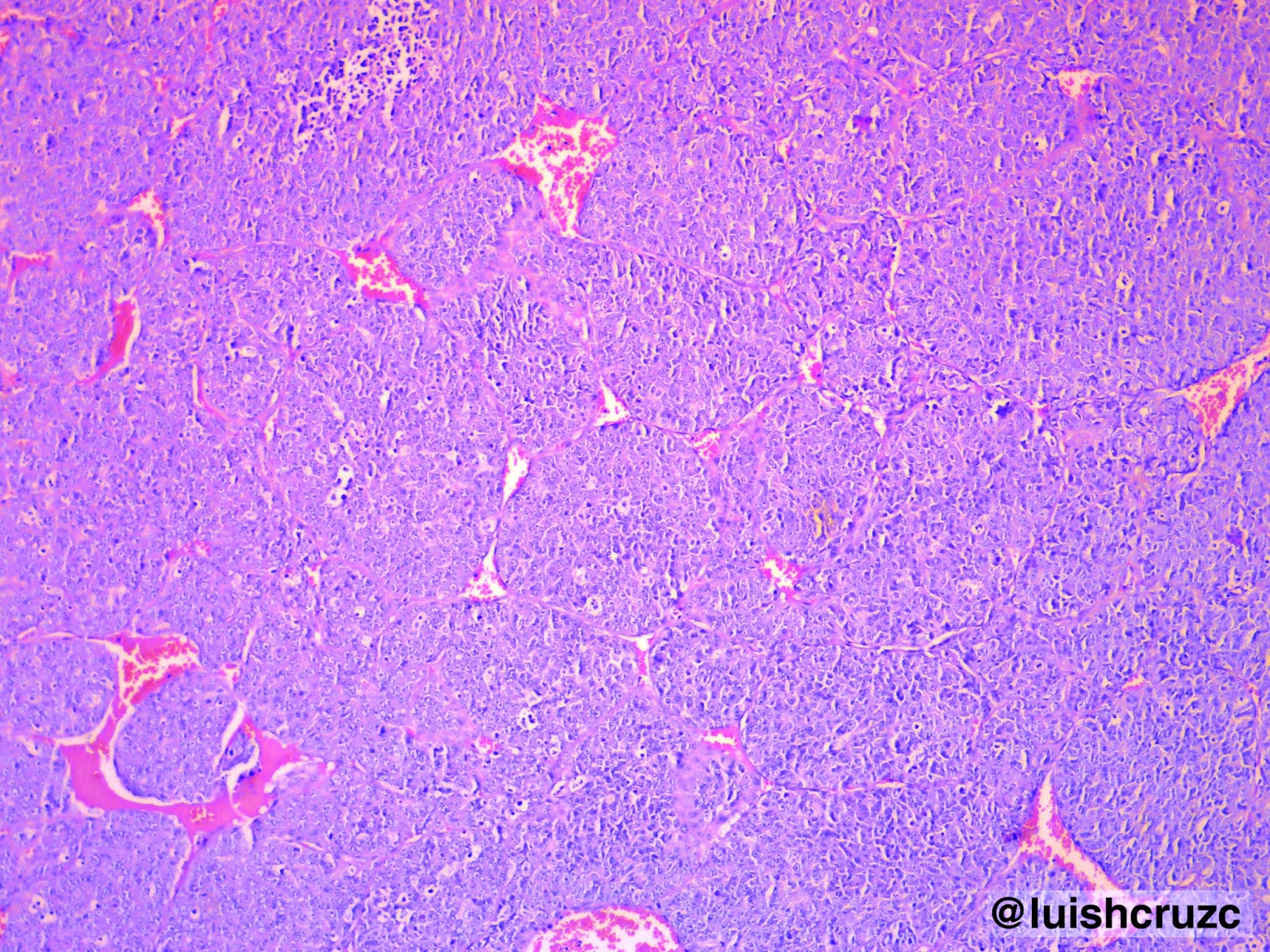 Patología CC: Sarcoma de Ewing / PNET