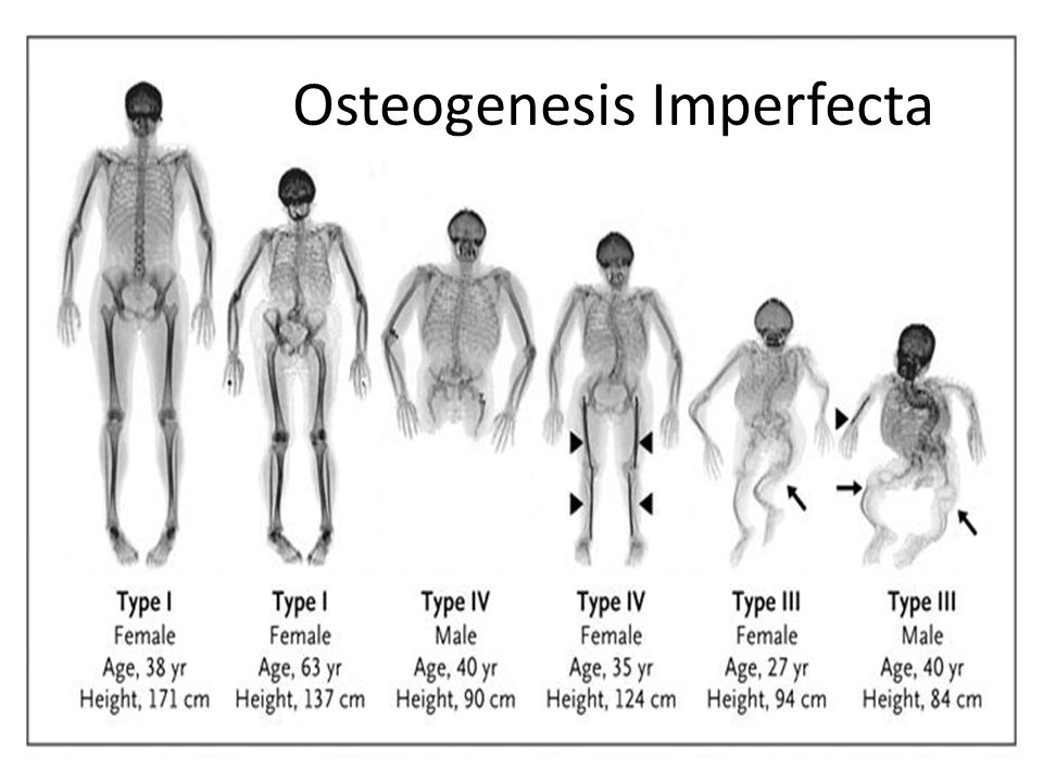 Cusevi y Pemaco: OSTEOGÉNESIS IMPERFECTA O HUESOS FRÁGILES