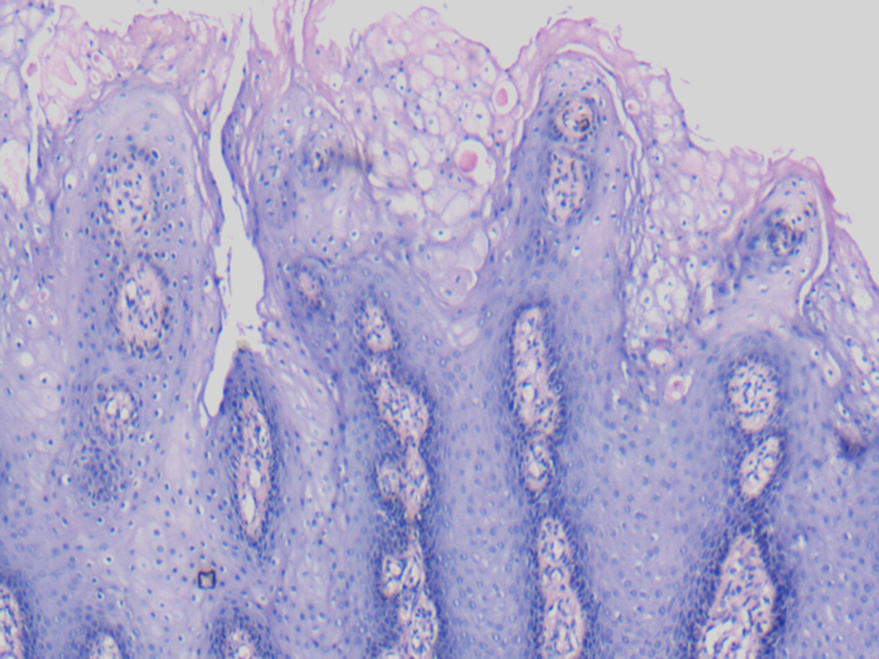 into the roots: Condyloma acuminatum