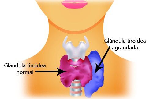 Dr. Tiroides Managua: Bocio