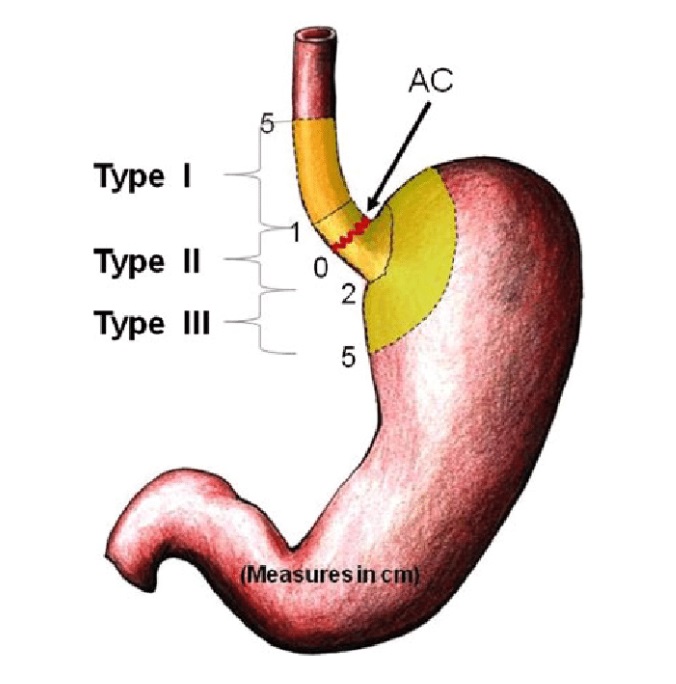 食道胃接合處癌症臨床分類：Siewert Classification