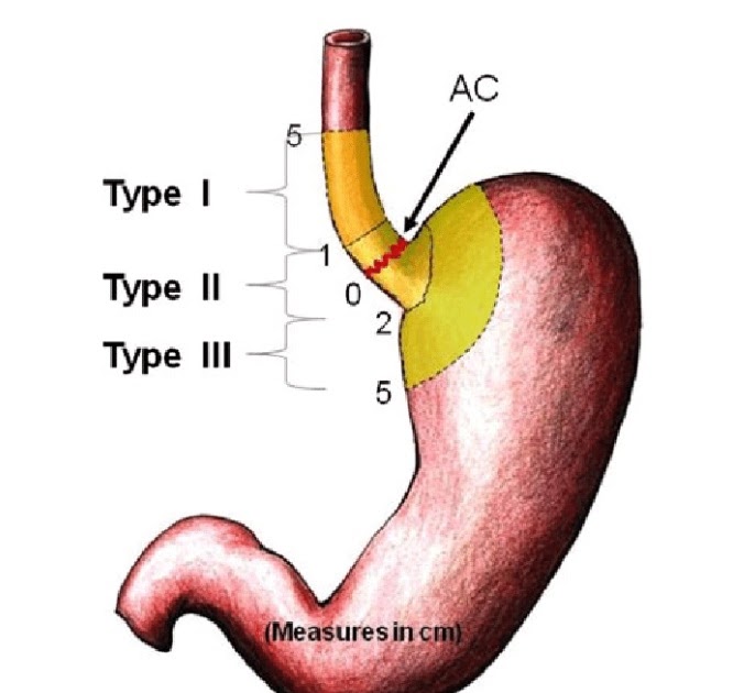 食道胃接合處癌症臨床分類：Siewert Classification