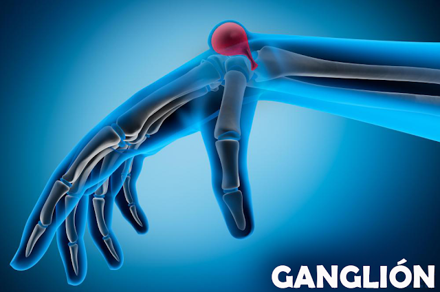 DrColumna: ¿QUÉ ES EL GANGLIÓN?