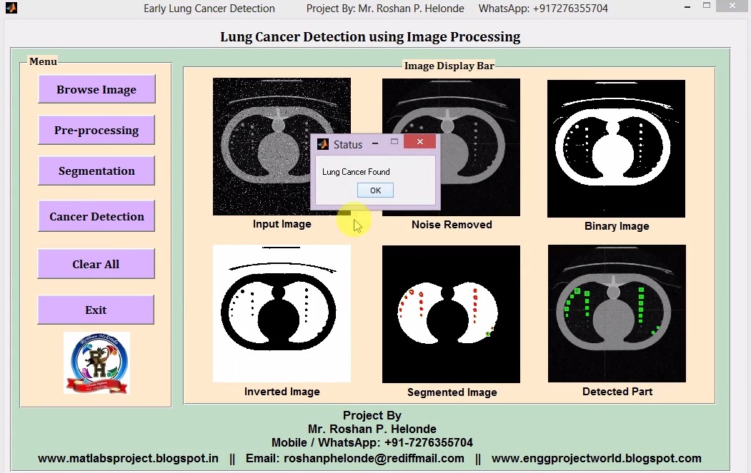 Matlab Code For Lung Cancer Detection Using Image Processing ~ Matlabs Code