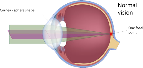 The Astigmatic Eye | Refraction in Astigmatism