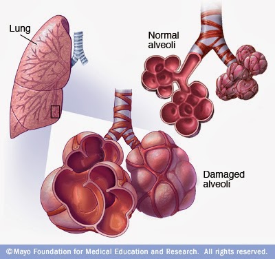 Signs of emphysema | Signs of emphysema