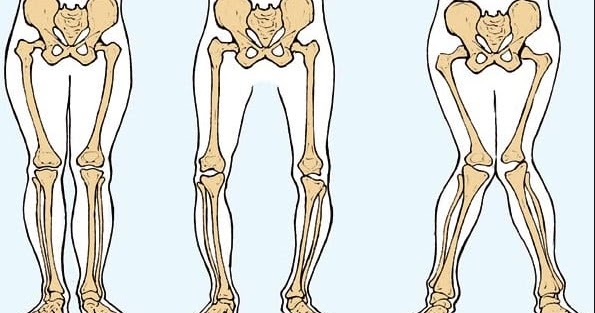 MAKALAH TENTANG RAHITIS | SUMBER DATA AGUNG