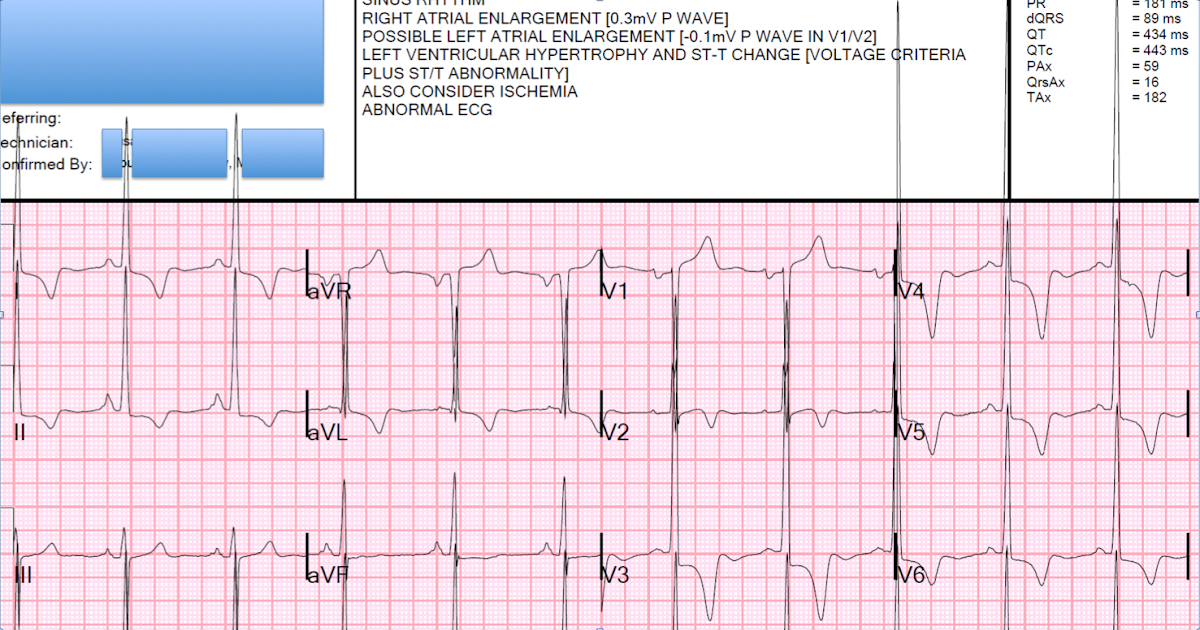 Dr. Smith's ECG Blog: Is this Acute Ischemia? More on LVH.