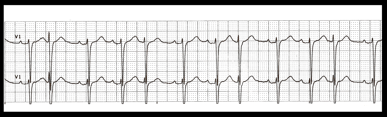 Practice EKG Strips 314