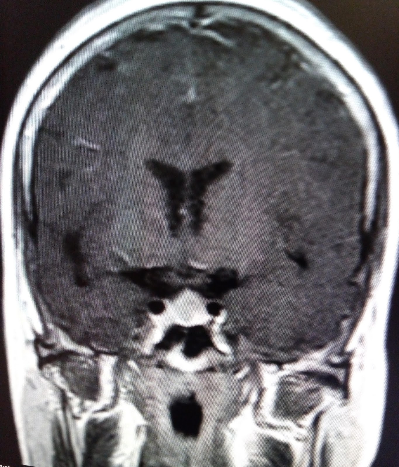 Rathke's Cleft Cyst: MRI - Sumer's Radiology Blog