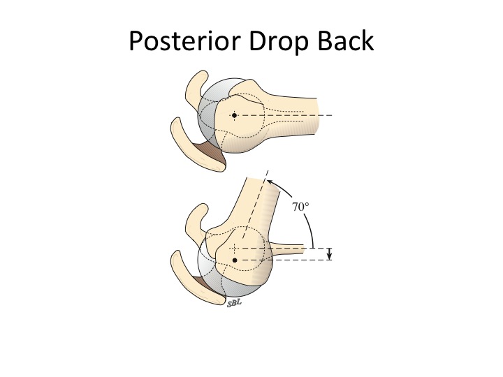 Shoulder Arthritis / Rotator Cuff Tears: causes of shoulder pain: Ream ...