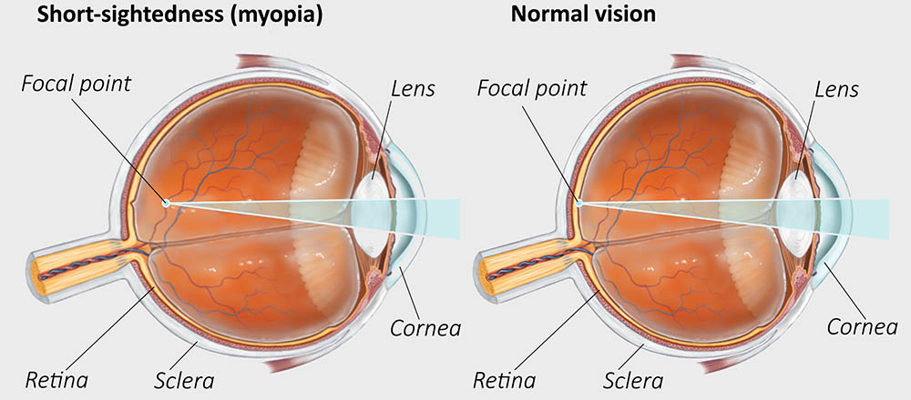 What is Myopia and its type