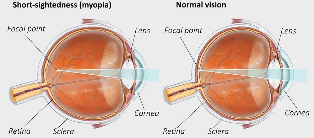 What is Myopia and its type