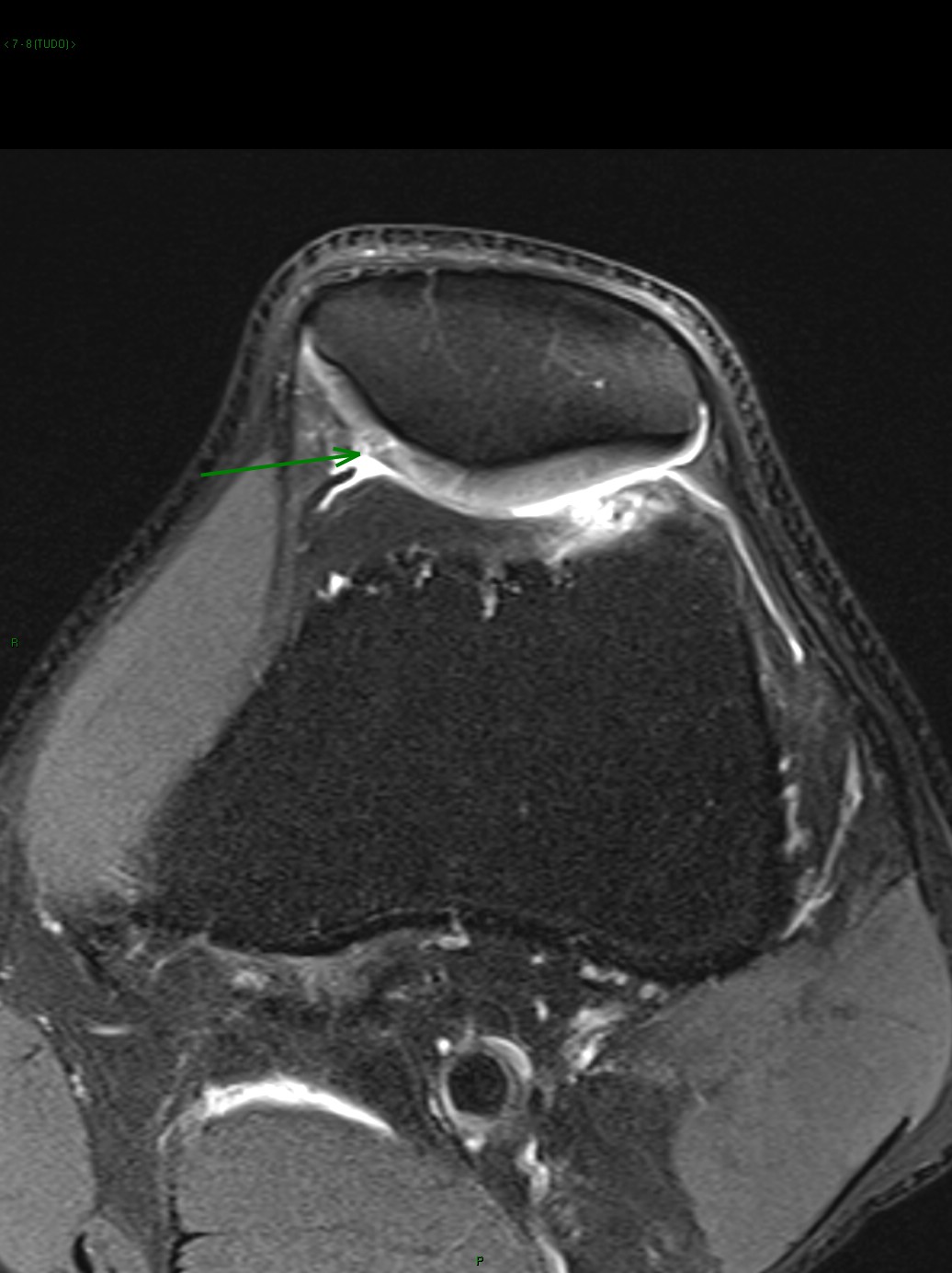 Patellar Condropathy (Condropatia Patelar)