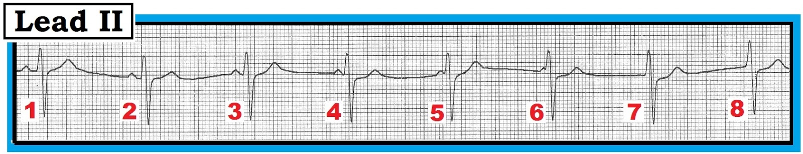 ECG Interpretation: ECG Interpretation Review #58 (2nd Degree - 3rd ...