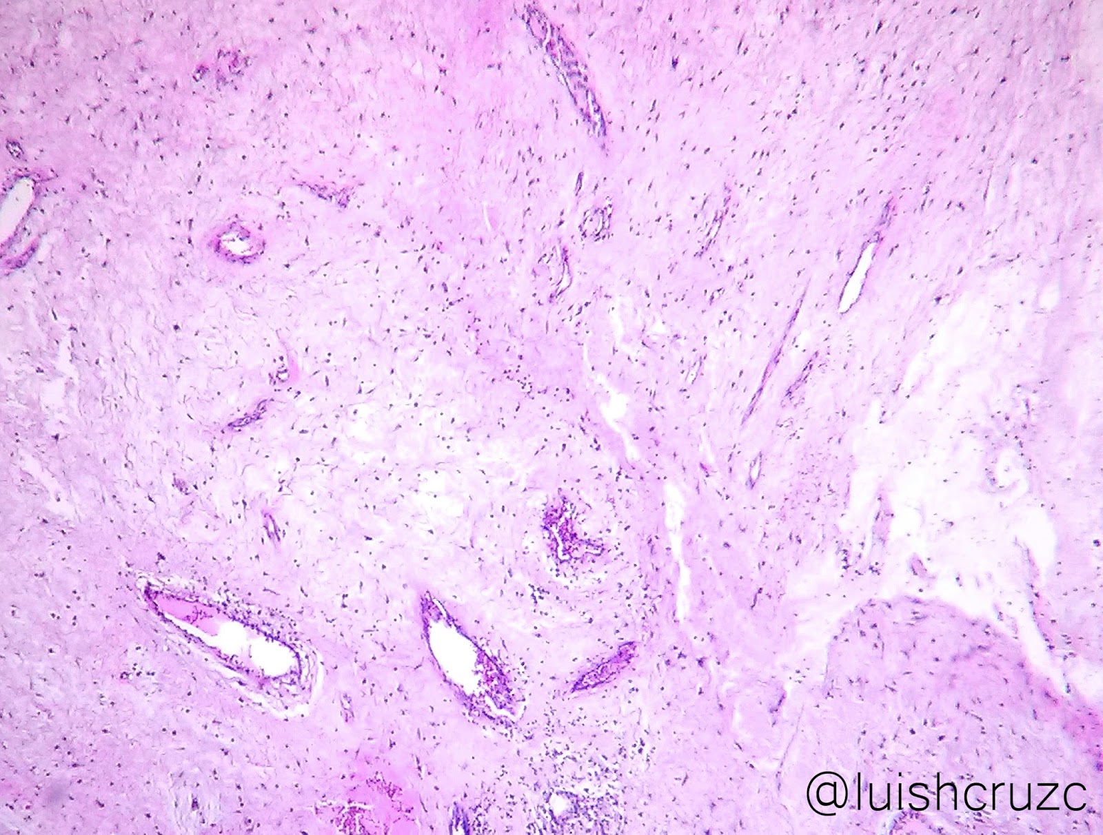 Patología CC: Angiomixoma profundo (agresivo)