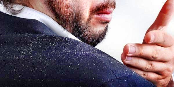 How to get rid of dandruff men | 100% effective solution | 7 days challenge