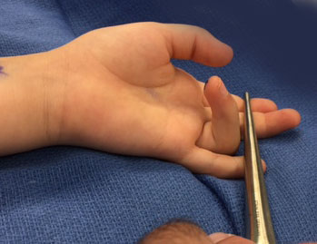 Bent Finger: Surgery for Camptodactyly | Congenital Hand and Arm ...