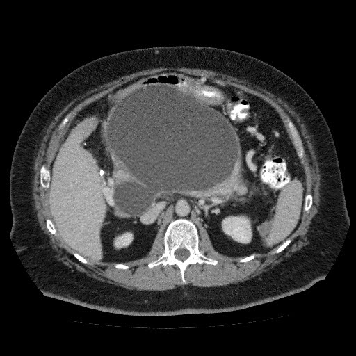 Buckeye Surgeon: Pancreatic Pseudocyst