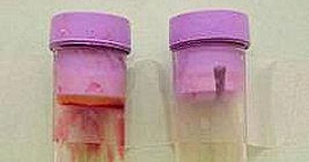 Medical Laboratory and Biomedical Science: Performing a Complete Blood ...