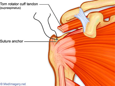 Healthy N Fit: Tips to treat Rotator cuff injury