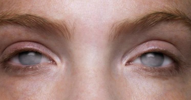 Clínica de Ojos Oftalmic Láser: Ceguera y pérdida de la visión