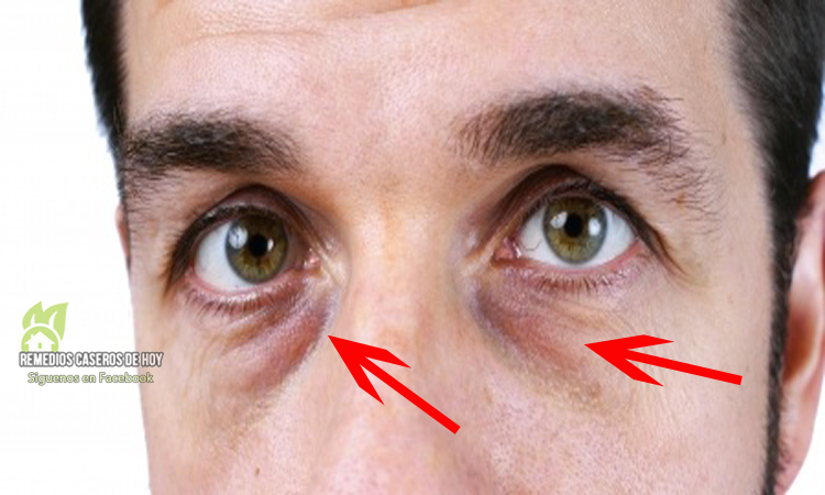 Cómo deshacerse de las ojeras en 4 minutos - Consejos y remedios