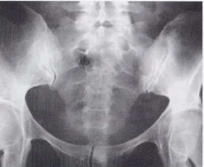 SACRO-COCCIX Y ARTICULACIONES SACROILIACAS