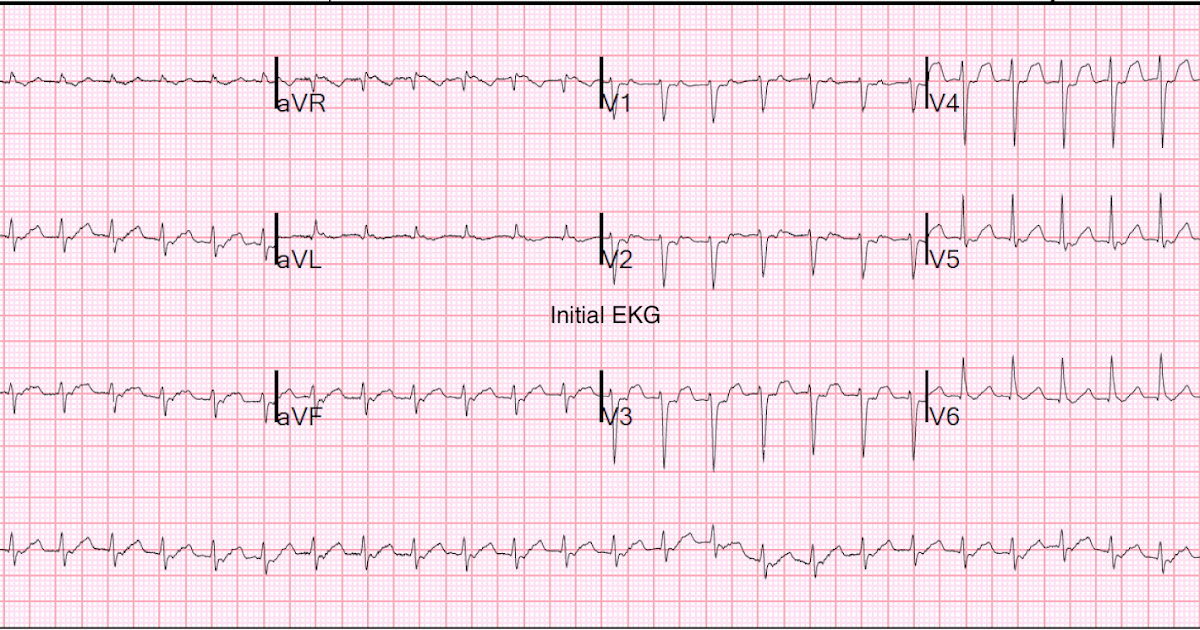 Dr. Smith's ECG Blog: Hypotensive and Tachycardic in Clinic: A Quick ...