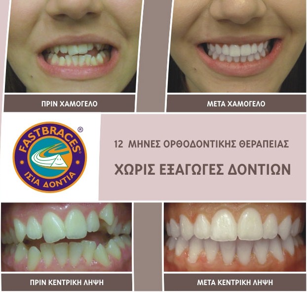 ΠΕΡΙΒΑΛΛΟΝ ΥΓΕΙΑ ΟΙΚΟΛΟΓΙΑ: ΟΡΘΟΔΟΝΤΙΚΗ (ΙΣΙΑ ΔΟΝΤΙΑ) ΣΕ ΛΙΓΟΤΕΡΟ ΧΡΟΝΟ ...
