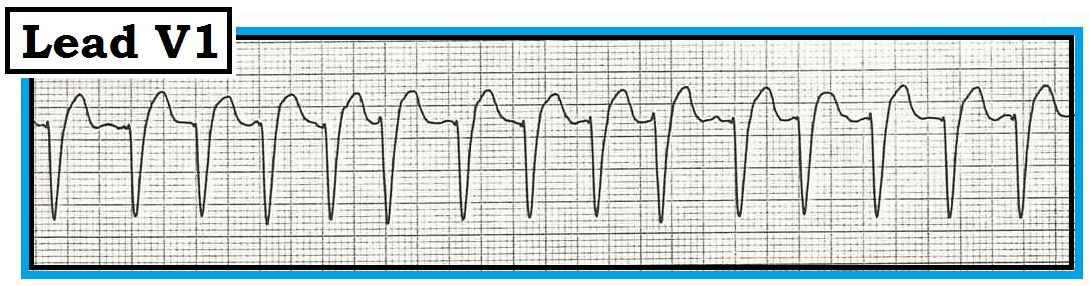 ECG Interpretation: ECG Interpretation Review #36: (WCT - VT - A Fib ...