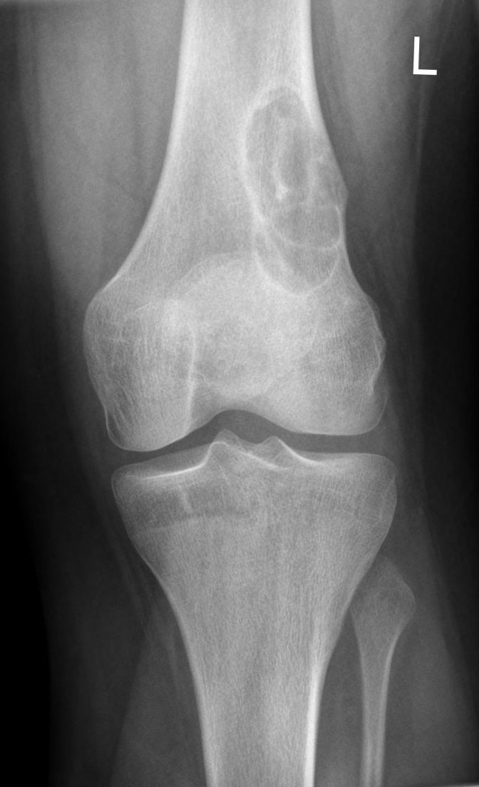 Metaphyseal Fracture Treatment Metaphyseal Fracture Surgery