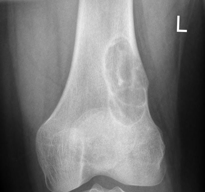 Metaphyseal Fracture Treatment Metaphyseal Fracture Surgery