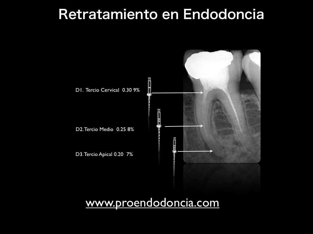 Proendodoncia.blogspot.com: Retratamiento en Endodoncia