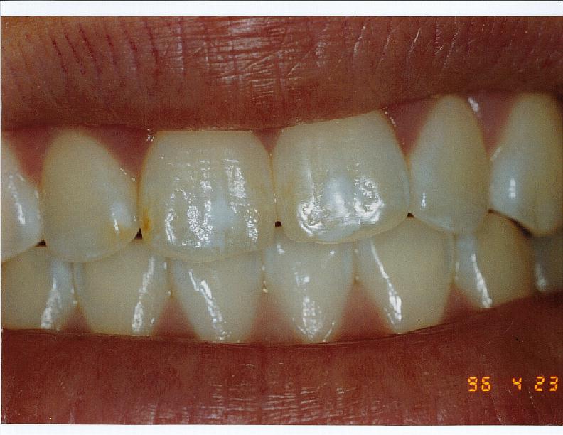 End Fluoride Milwaukee: DENTAL FLUOROSIS, THE FLUORIDE DISEASE