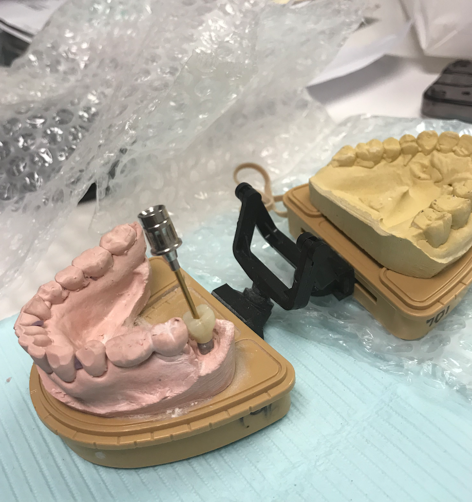 Dental Info: Angled screw channels for screw retained implant crowns?