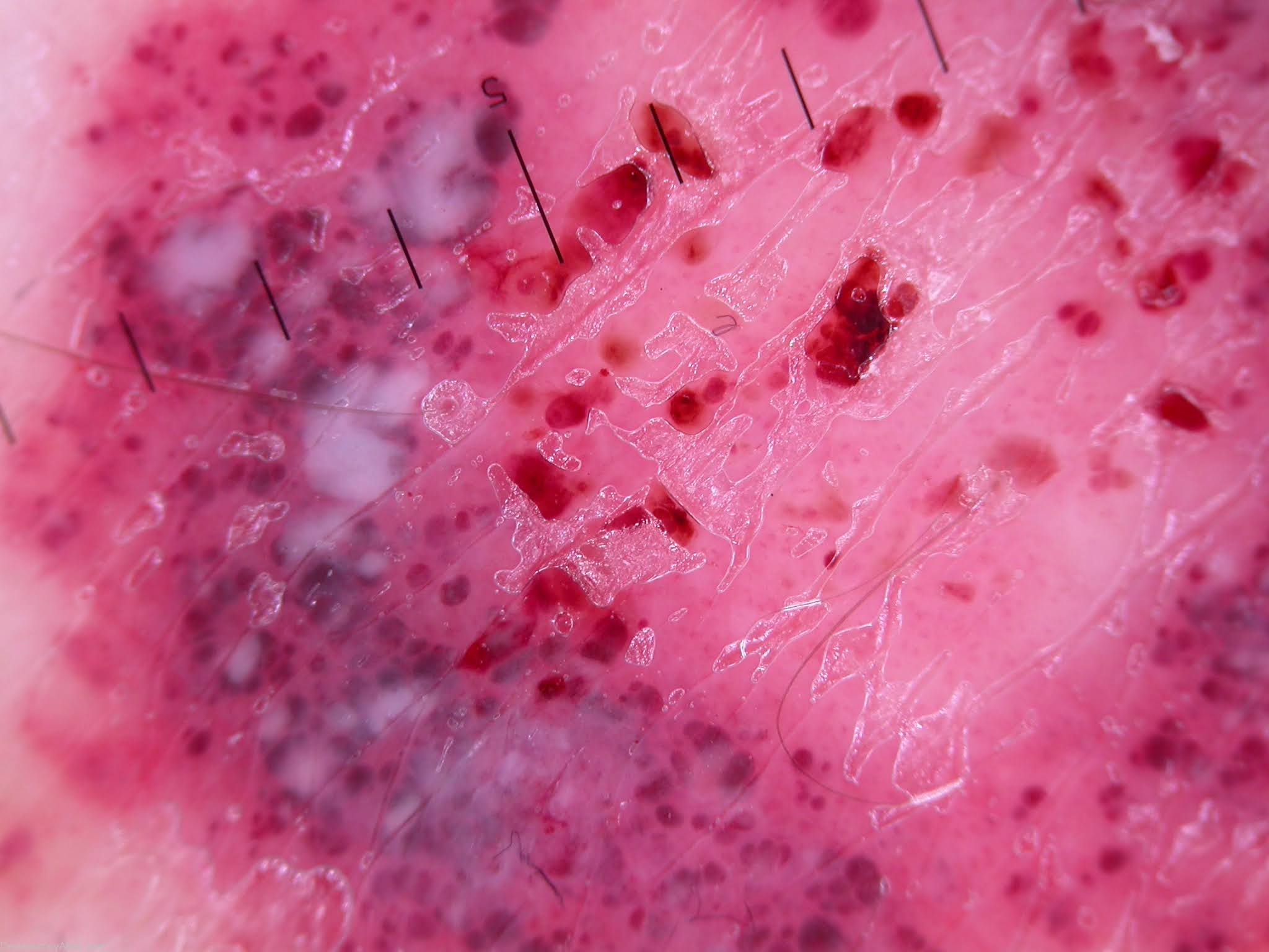 Dermoscopy Features as Clues: Clods Red