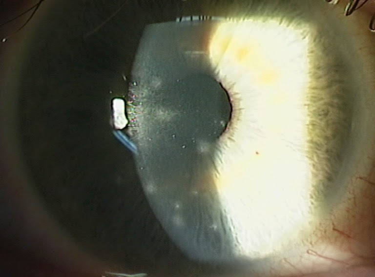 All things eye | Por Yong Ming: Conjunctivitis: What you should do if ...